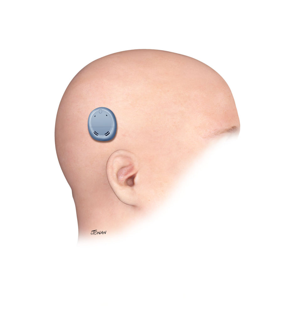 Grupo de Implante Coclear do Hospital das Clínicas e FMUSP