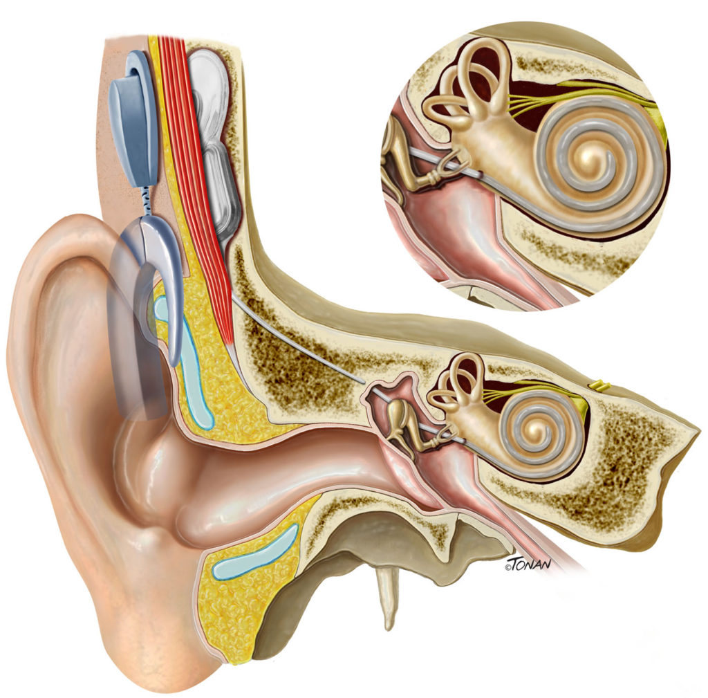Grupo de Implante Coclear do Hospital das Clínicas e FMUSP